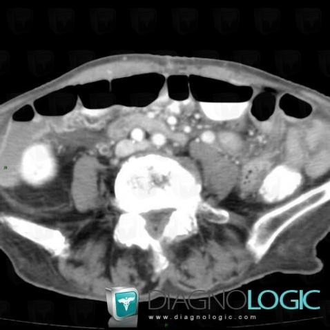Radiology case : Deep venous thrombosis (CT) - Diagnologic