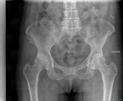 Radiology case : CPPD (X rays) - Diagnologic