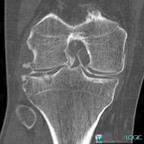 Radiology case : Subchondral cyst (CT ,MRI ,X rays) - Diagnologic