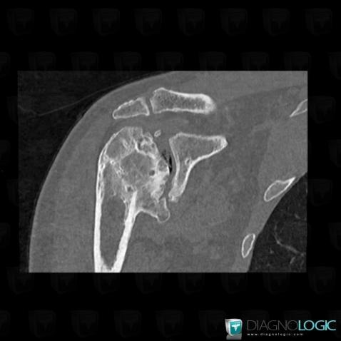 Radiology case : Degenerative joint disease (CT) - Diagnologic