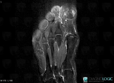 Radiology case : Degenerative joint disease (MRI) - Diagnologic