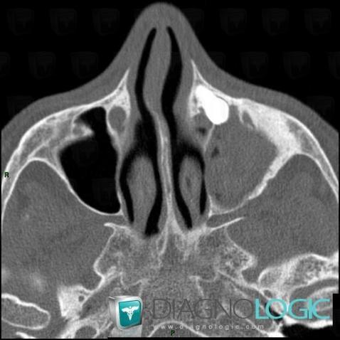 Cas radiologie : Dent incluse (Scanner) - Diagnologic