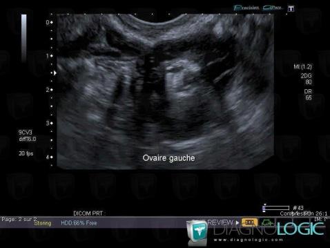 Radiology case : Dermoid cyst (US) - Diagnologic