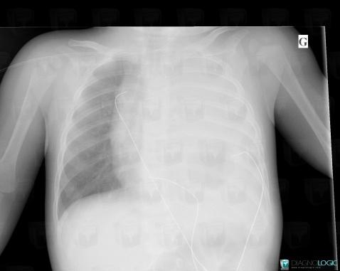 Radiology case : Diaphragmatic hernia (X rays) - Diagnologic