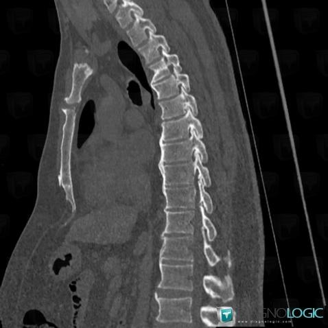 Radiology case : Diffuse idiopathic skeletal hyperostosis (CT ...