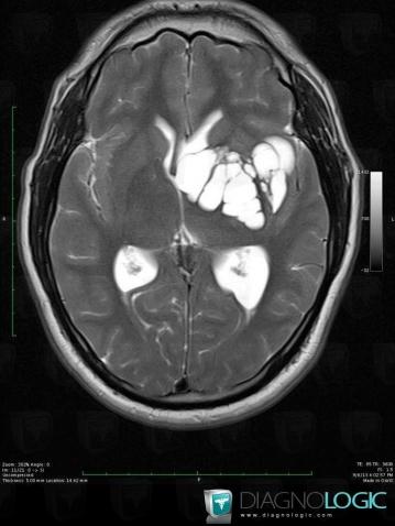 Radiology case : Dilatation of the Virchow Robin space (MRI) - Diagnologic