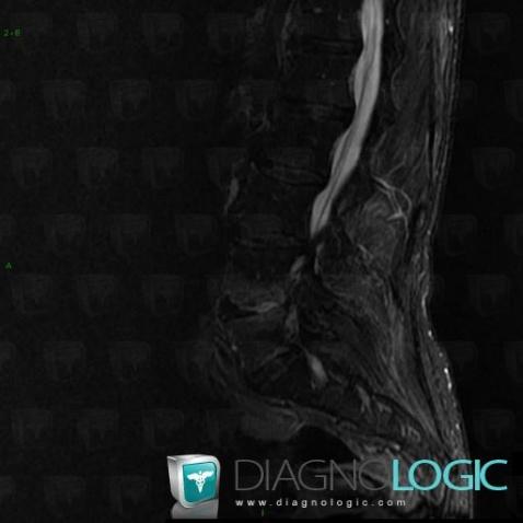 Cas radiologie : Discopathie dégénérative (IRM) - Diagnologic