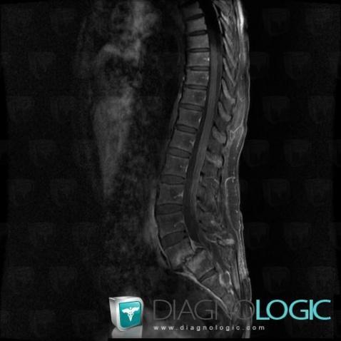 Cas radiologie : Discopathie dégénérative (IRM) - Diagnologic