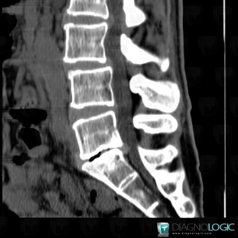 Cas radiologie : Discopathie dégénérative (Scanner) - Diagnologic
