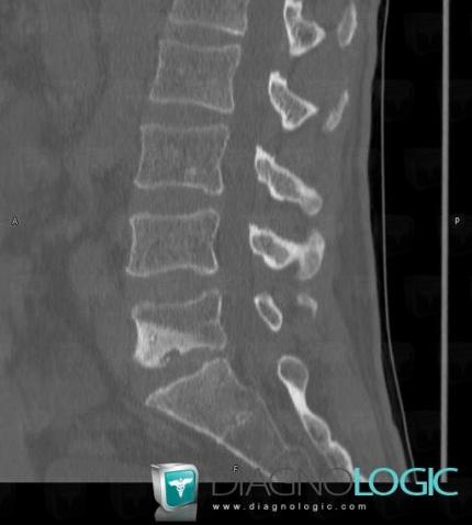 Cas radiologie : Discopathie dégénérative (TDM) - Diagnologic