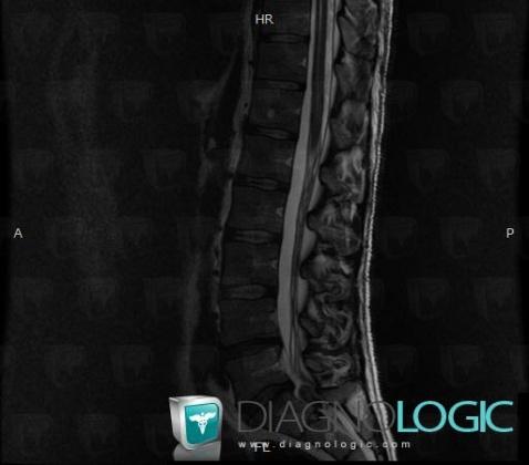 Radiology case : Disk sequestration (MRI) - Diagnologic