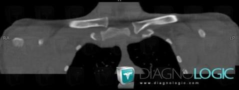Radiology case : Dislocation (CT) - Diagnologic