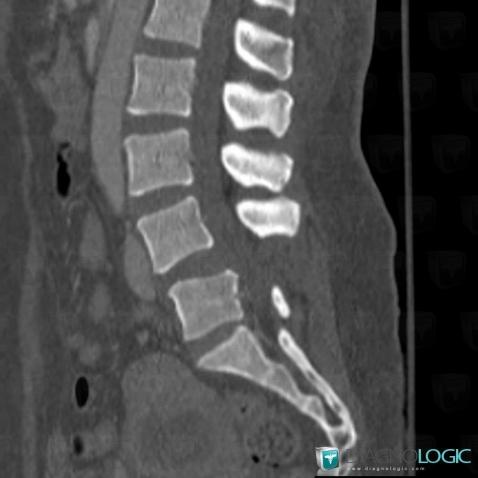 Radiology case : Dislocation (CT) - Diagnologic