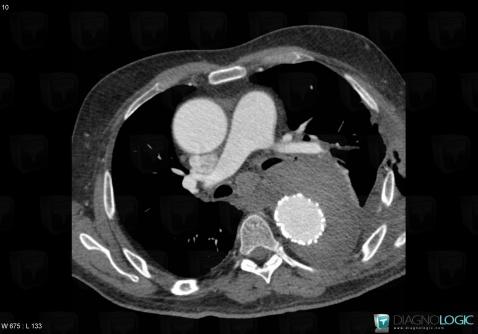 Cas radiologie : Dissection aortique (Scanner) - Diagnologic