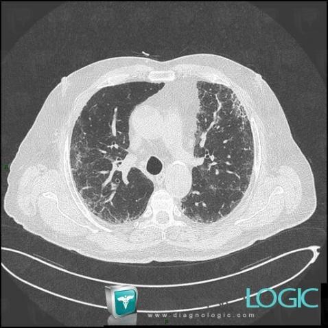 Radiology case : Drug induced pulmonary fibrosis (CT) - Diagnologic