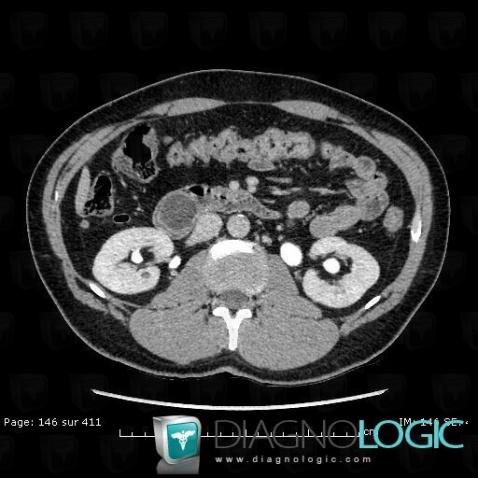 Radiology case : Duplication cyst (CT) - Diagnologic