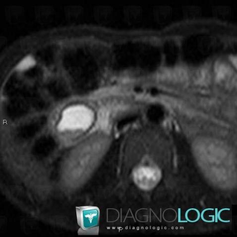 Radiology case : Duplication cyst (MRI) - Diagnologic