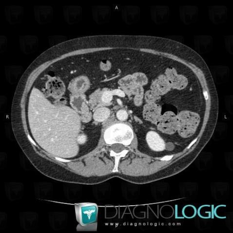 Radiology case : Ectopic pancreas (CT) - Diagnologic