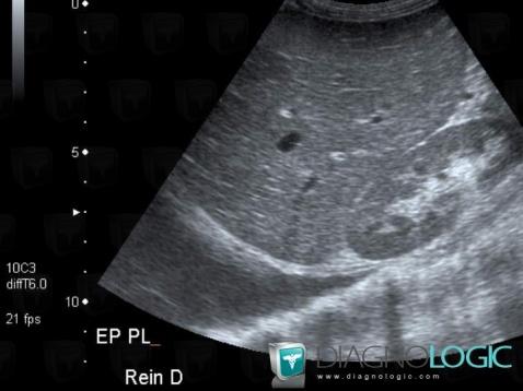 Cas radiologie : Empyème (Echographie) - Diagnologic