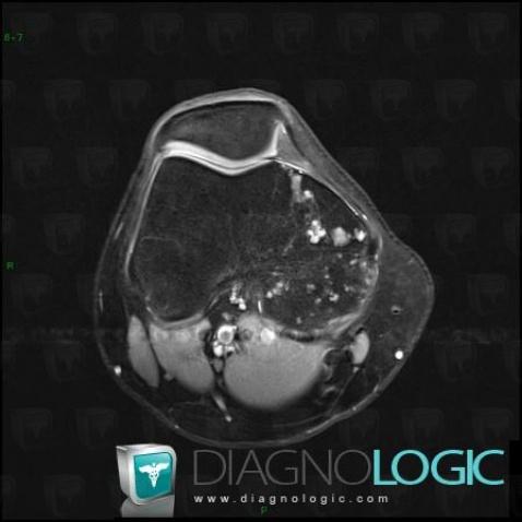 Enchondroma Mri The Role Of Magnetic Resonance Imaging In The