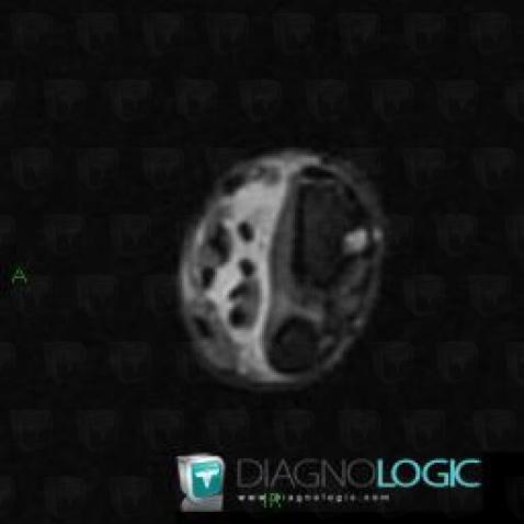 Cas radiologie : Enchondromatose (Scanner ,IRM) - Diagnologic