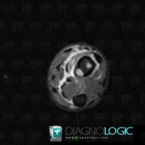 Cas radiologie : Enchondromatose (Scanner ,IRM) - Diagnologic
