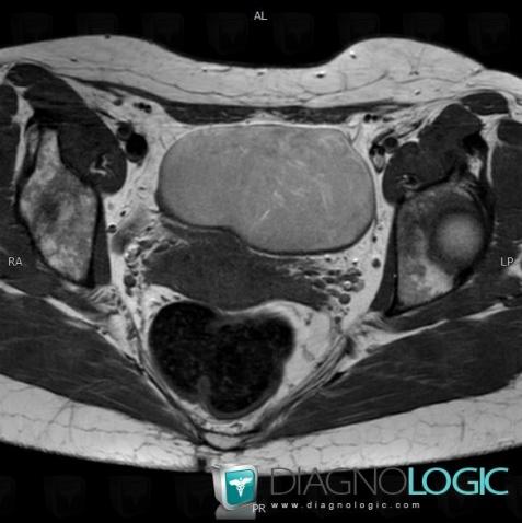 Radiology case : Endometrioma (MRI) - Diagnologic