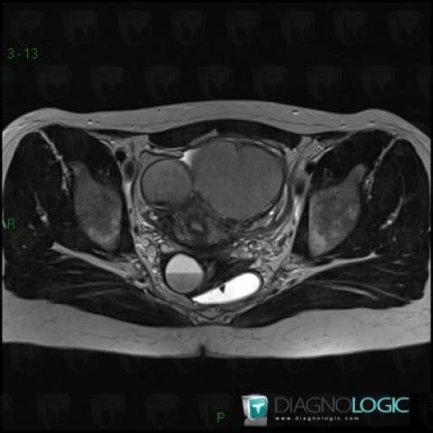 Radiology case : Endometriosis (MRI ,X rays ,CT) - Diagnologic