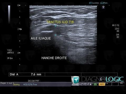 Radiology case : Enthesopathy - Tendinopathy / Pelvis (US) - Diagnologic