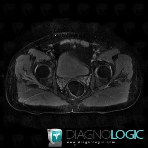 Radiology case : Enthesopathy - Tendinopathy / Pelvis (MRI) - Diagnologic