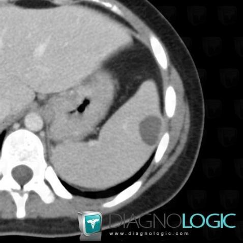 Radiology case : Epidermoid cyst (CT) - Diagnologic