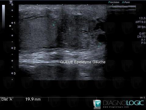 Cas radiologie : épididymite (Echographie) - Diagnologic