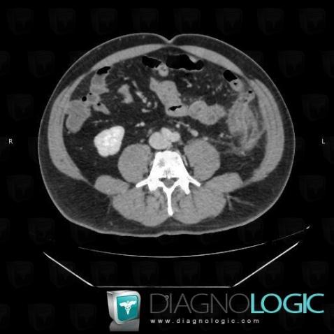 Radiology case : Epiploic appendagitis (CT) - Diagnologic