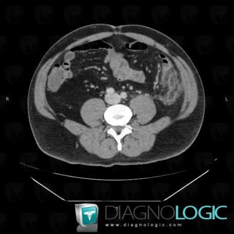 Radiology case : Epiploic appendagitis (CT) - Diagnologic