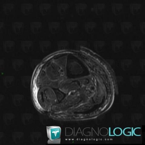 Radiology case : Erysipelas (MRI) - Diagnologic