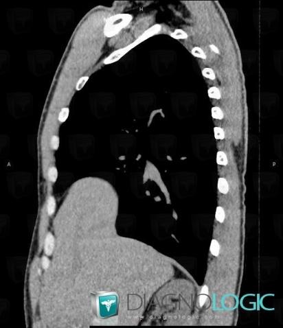 Radiology case : Eventration of diaphragm (CT) - Diagnologic