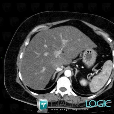 Radiology case : Fatty infiltration (CT) - Diagnologic