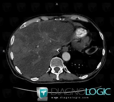 Radiology case : Metastasis (CT) - Diagnologic