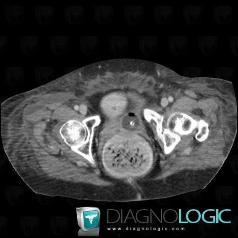 Radiology case : Feces (CT) - Diagnologic