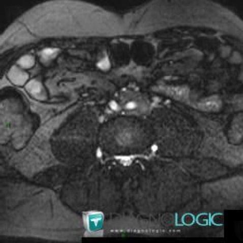 Cas radiologie : Fibrose rétropéritonéale (Scanner ,IRM) - Diagnologic
