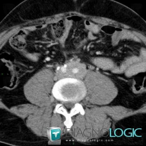 Cas radiologie : Fibrose rétropéritonéale (Scanner ,IRM) - Diagnologic