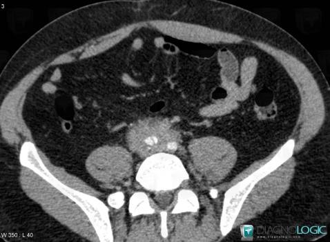 Cas radiologie : Fibrose rétropéritonéale (Scanner) - Diagnologic