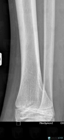 Radiology case : Fibrous cortical defect (X rays) - Diagnologic