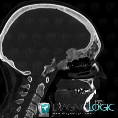 Sphenoid Bone Fibrous Dysplasia Radiopaedia
