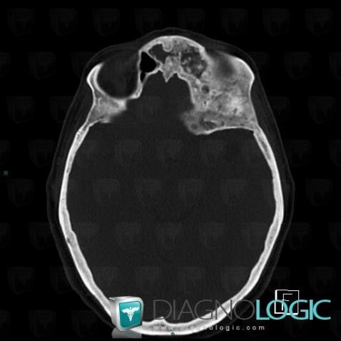 Fibrous Dysplasia Skull Bone Scan Fibrous Dysplasia, CT Scan Stock