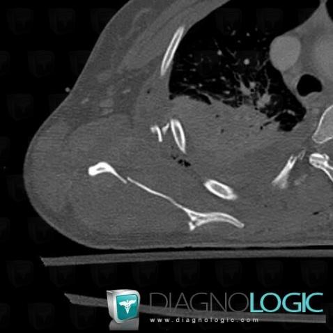 Cas radiologie : Lacération (Scanner) - Diagnologic