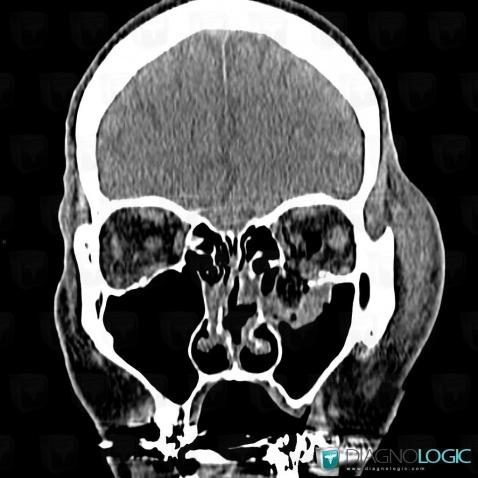 Radiology case : Posttraumatic (CT) - Diagnologic