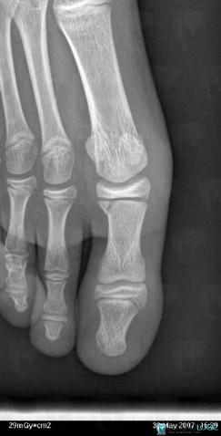 Cas radiologie : Fracture (Radio) - Diagnologic