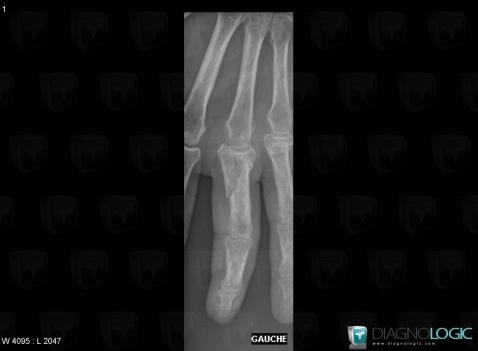 Radiology case : Fracture (X rays) - Diagnologic
