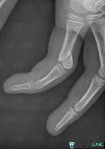 Radiology case : Fracture (X rays) - Diagnologic